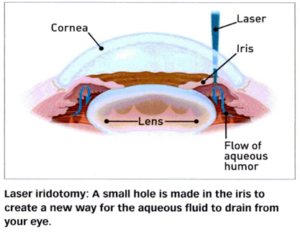 YAG Laser Iridotomy