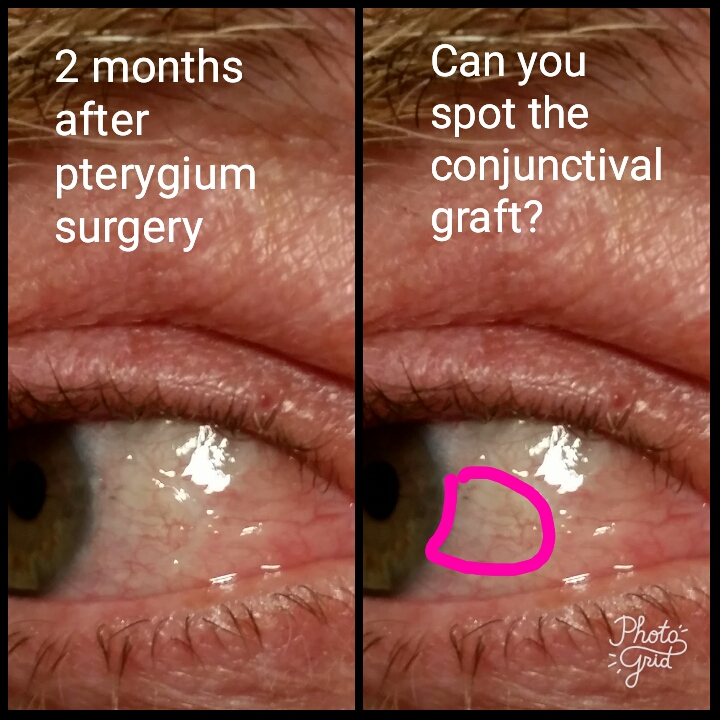 Pterygium Surgery pterygium-surgery